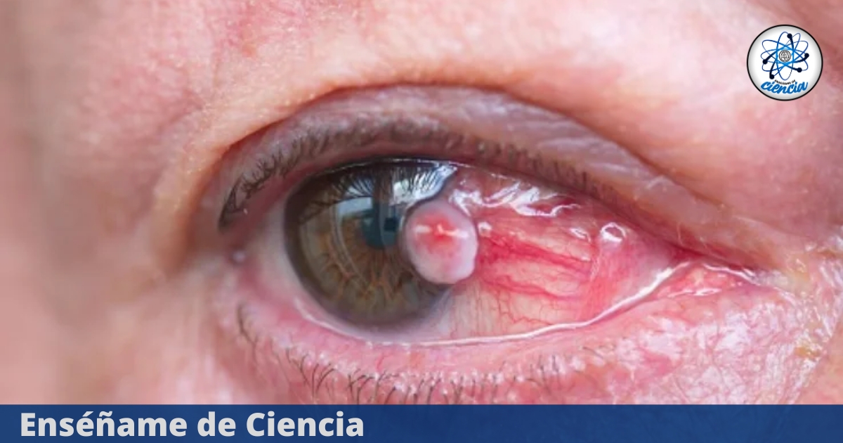 Estos son los síntomas característicos del cáncer de ojo, no los ...