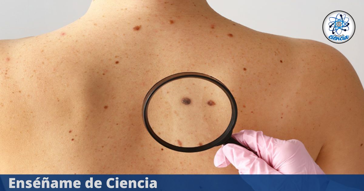Lunares: cómo saber si son malignos y cuáles son los síntomas que ...